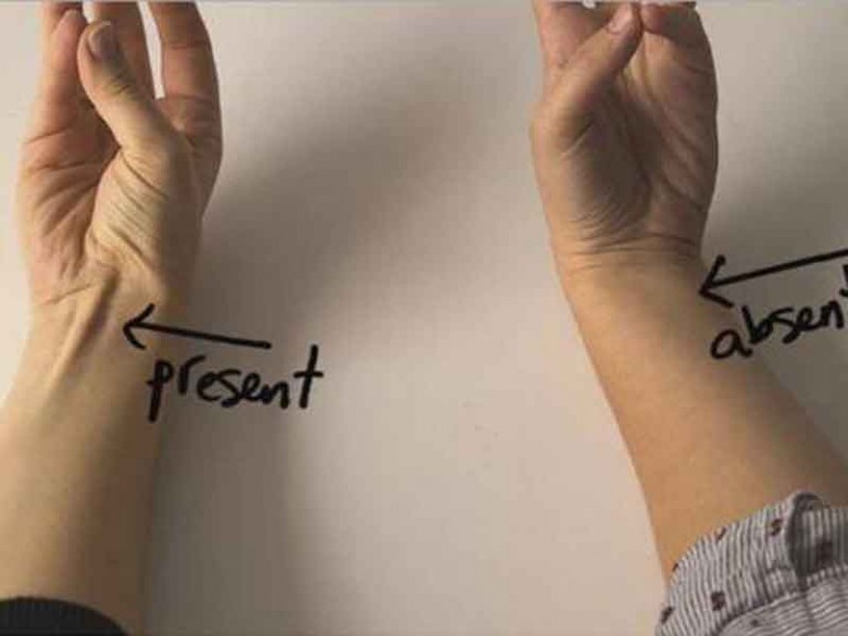Palmar largo, músculo que refuerza la teoría de la evolución - Norte de ...